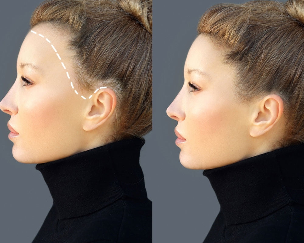 How to Choose the Best Hair Patch for Men - Bglam Hair Studio